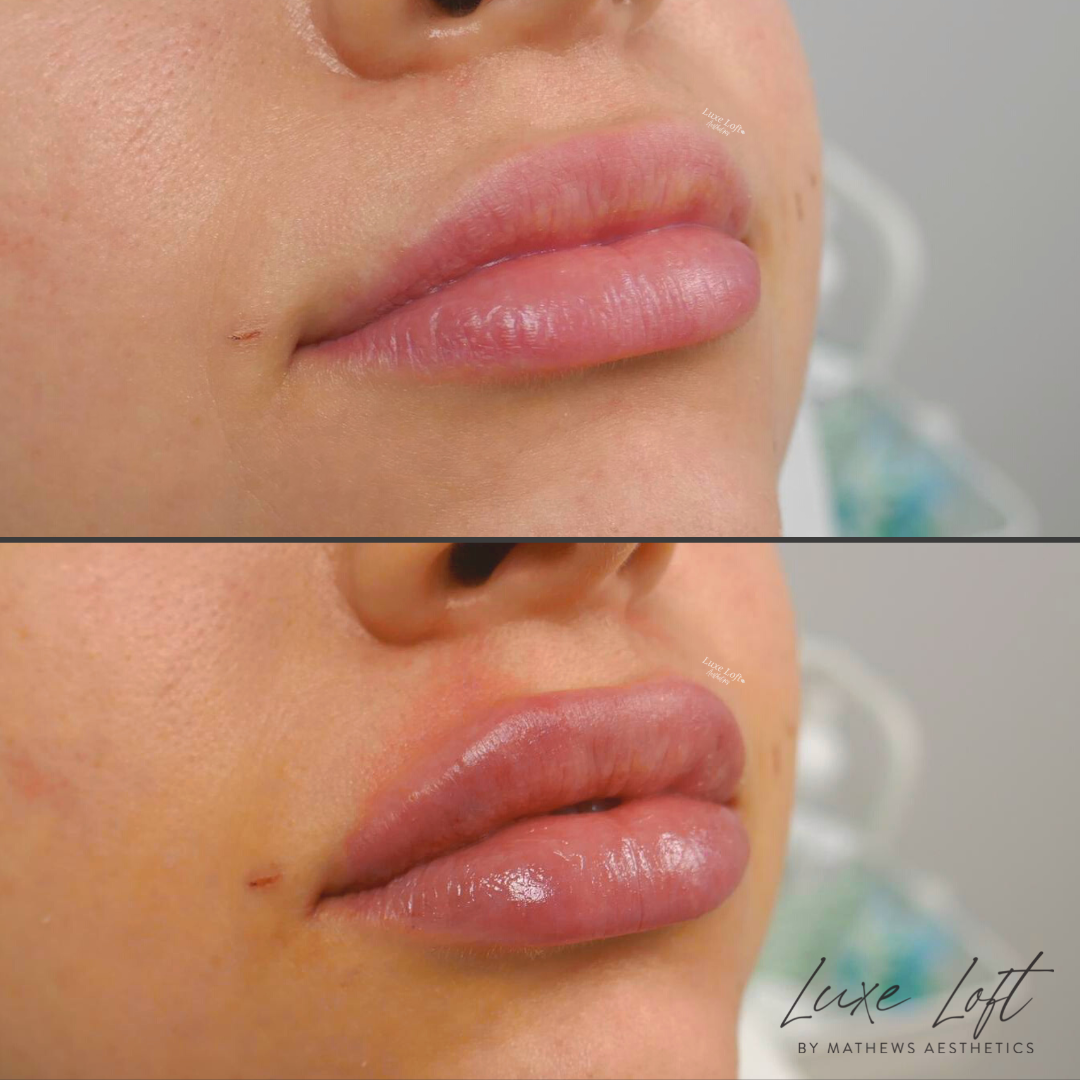 LIP FILLER GALLERY | See Stunning Transformations — Luxe Loft