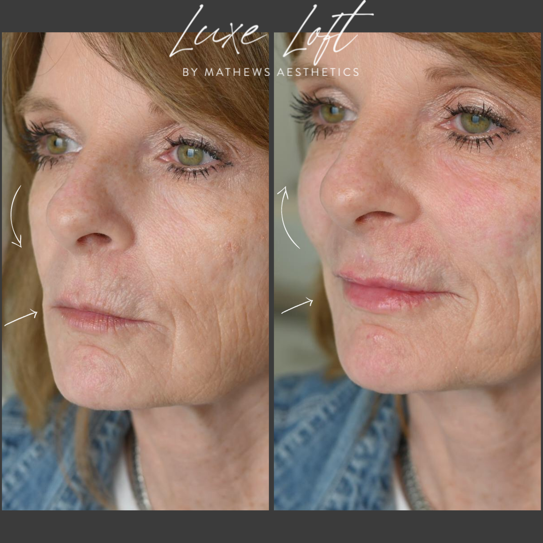 FILLER GALLERY | Unleash Your Beauty — Luxe Loft