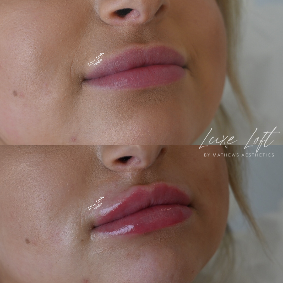 LIP FILLER GALLERY — Luxe Loft
