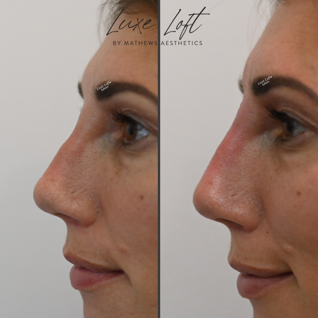 FILLER GALLERY | Unleash Your Beauty — Luxe Loft