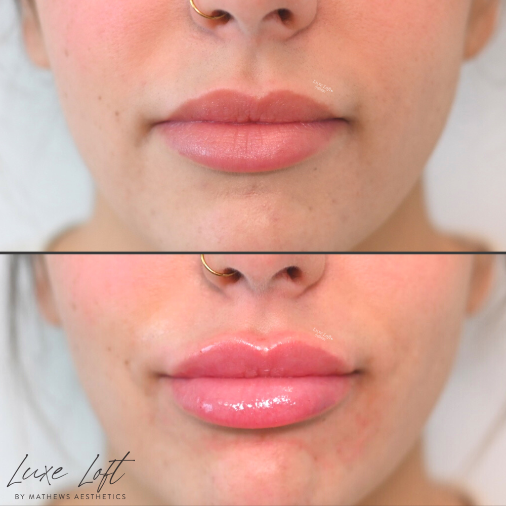 LIP FILLER GALLERY | See Stunning Transformations — Luxe Loft