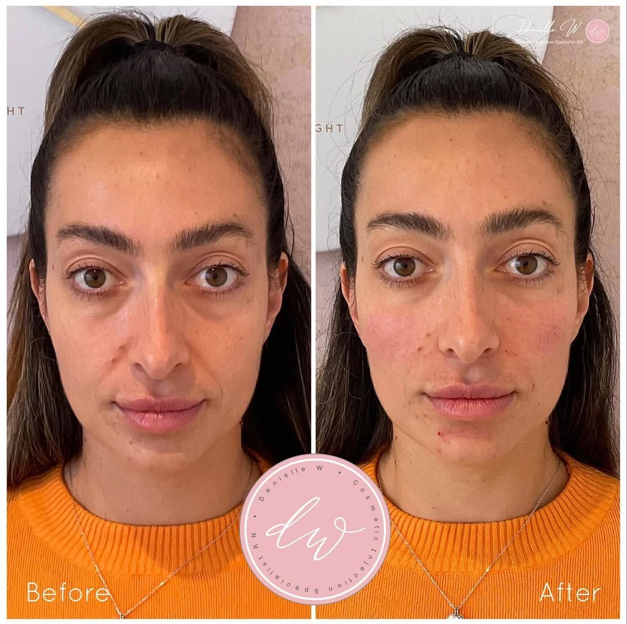 Dermal Fillers — The Beauty Collective