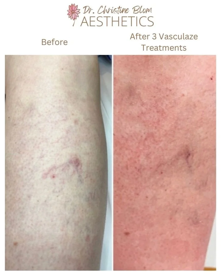 Vasculaze — Dr. Christine Blom Aesthetics