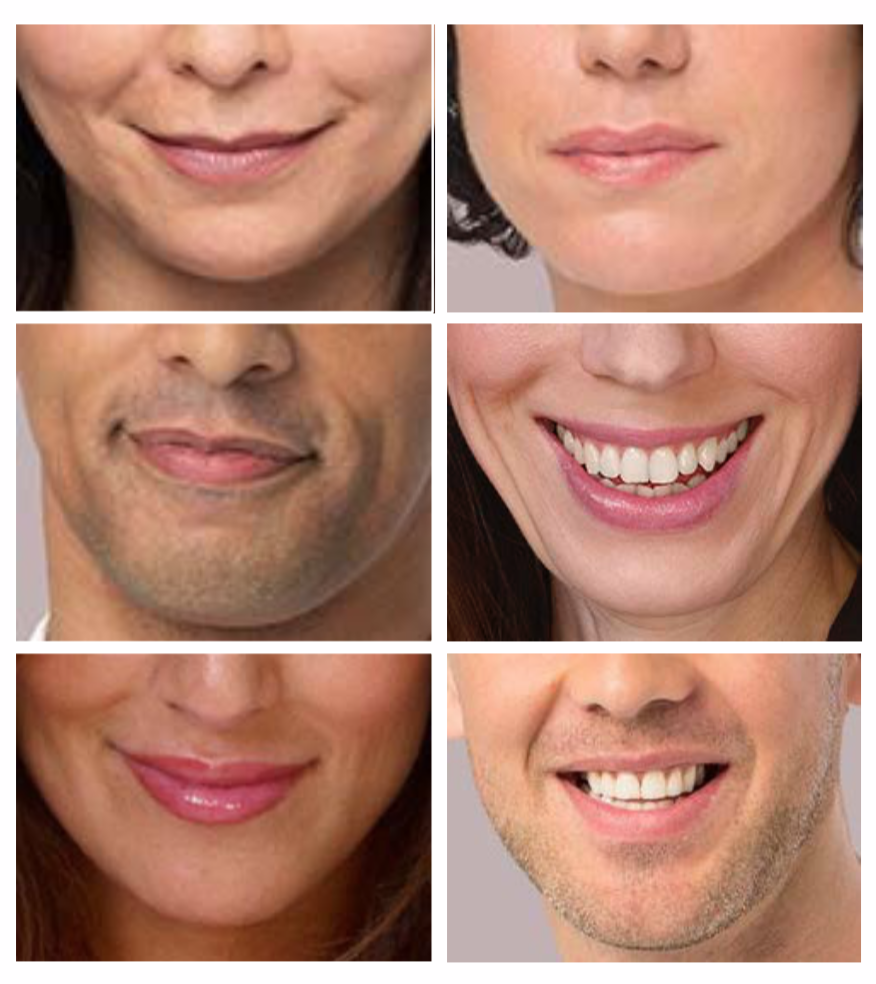 Thinning Lips — Dr. Christine Blom Aesthetics