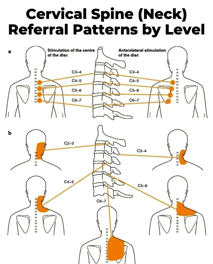 Cervical Spine Pain Referral Patterns by Level — EPOCH HEALTH