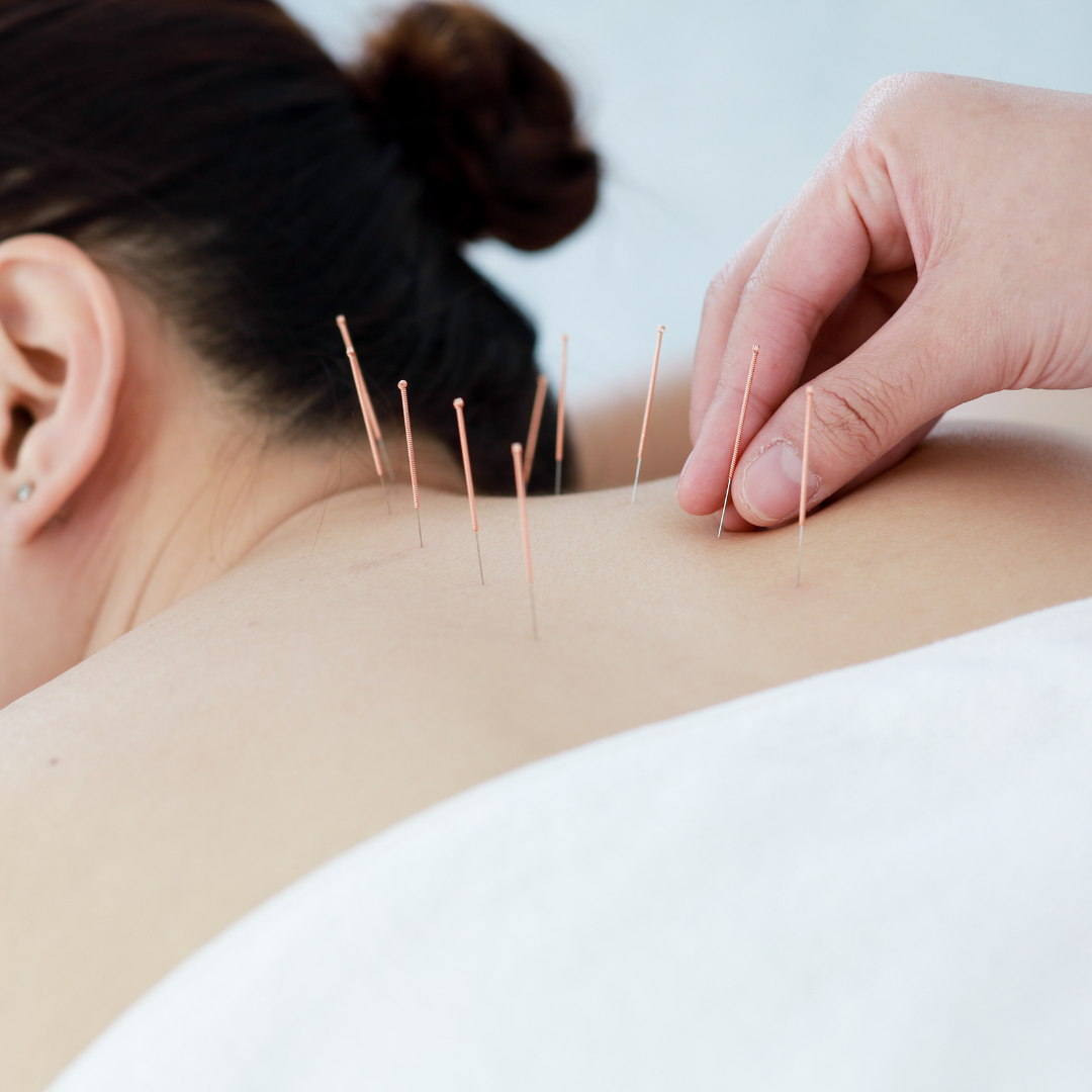 Acupuncture — Medical Acucare