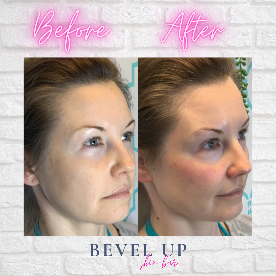 Why Do I Need Cheek Filler? — Even Esthetics™