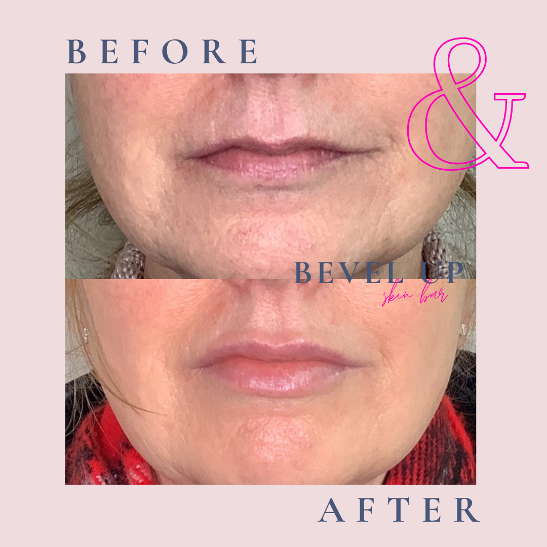 6 Reasons Lip Filler Could Be Your Next Favorite Treatment — Even ...