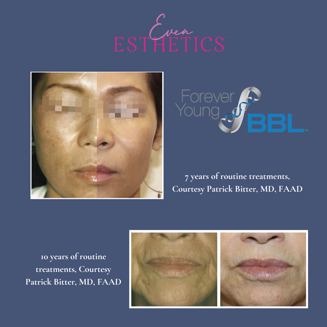 Prevent and Reverse Signs of Aging with Forever Young BBL — Even Esthetics™