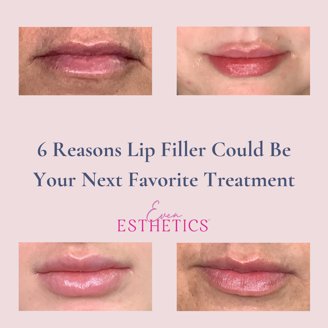 6 Reasons Lip Filler Could Be Your Next Favorite Treatment — Even ...