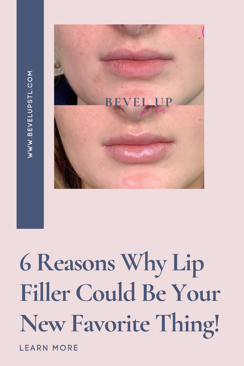 6 Reasons Lip Filler Could Be Your Next Favorite Treatment — Even ...