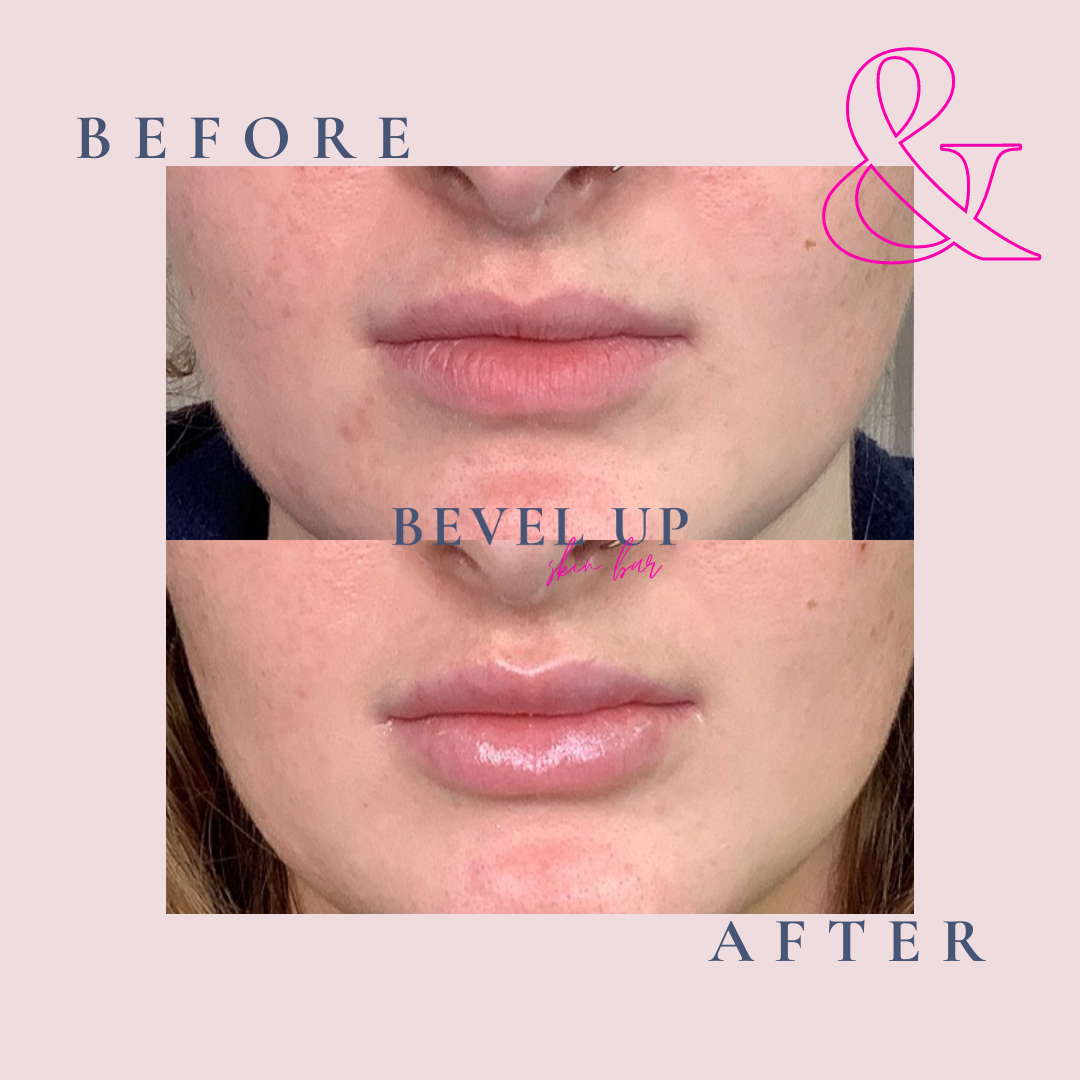 6 Reasons Lip Filler Could Be Your Next Favorite Treatment — Even ...