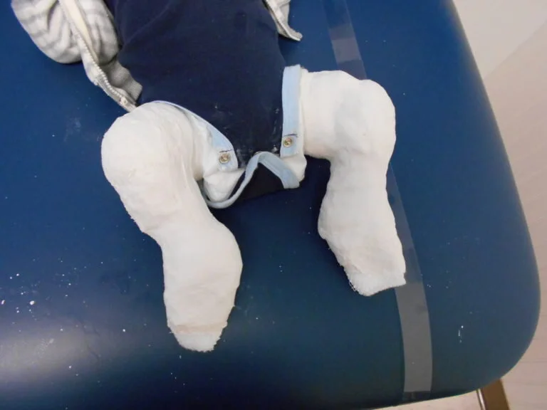 Clubfoot Treatment | Pediatric Orthopedics of Brandon and Riverview