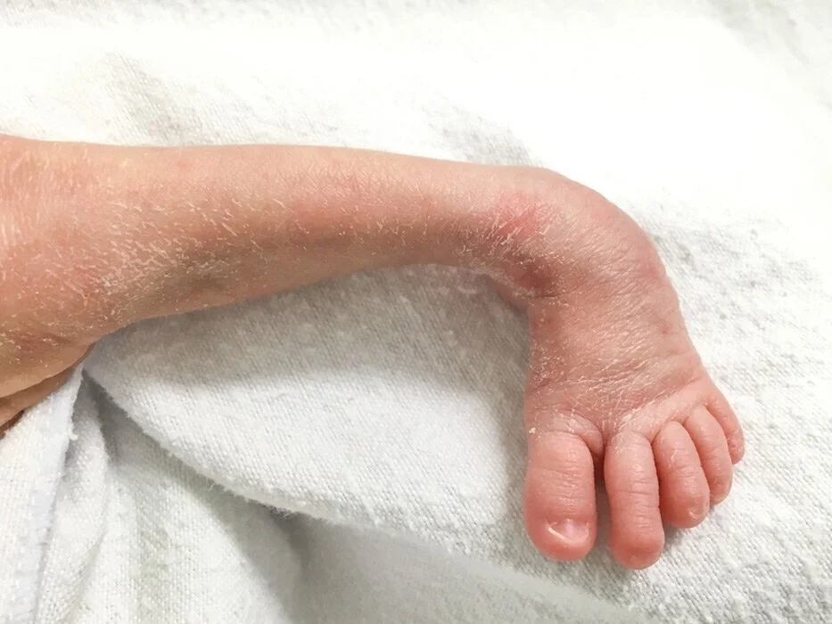 Clubfoot Treatment | Pediatric Orthopedics of Brandon and Riverview