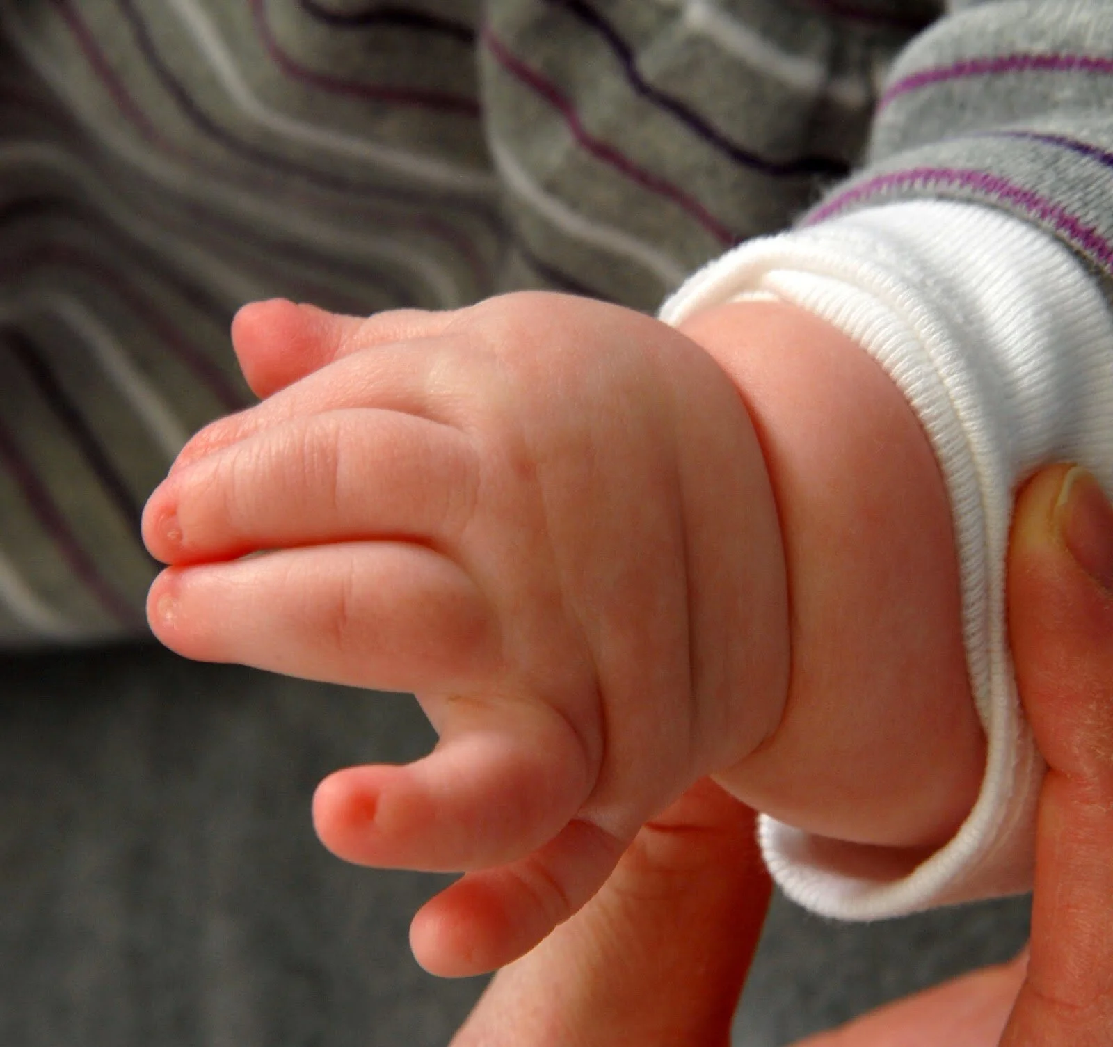 Newborn Polydactyly | POBAR