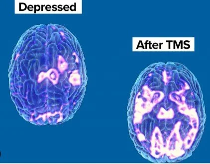 TMS — Trimera Health
