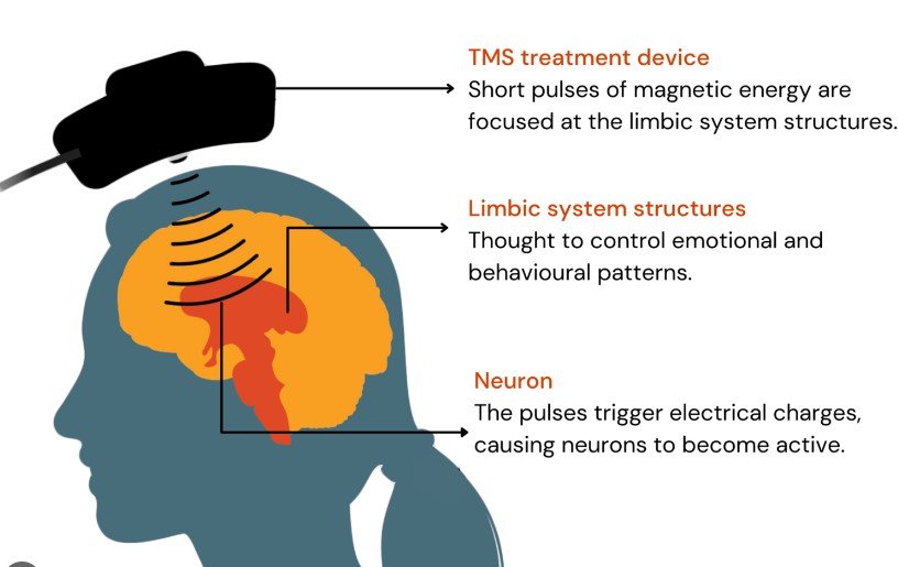 TMS — Trimera Health