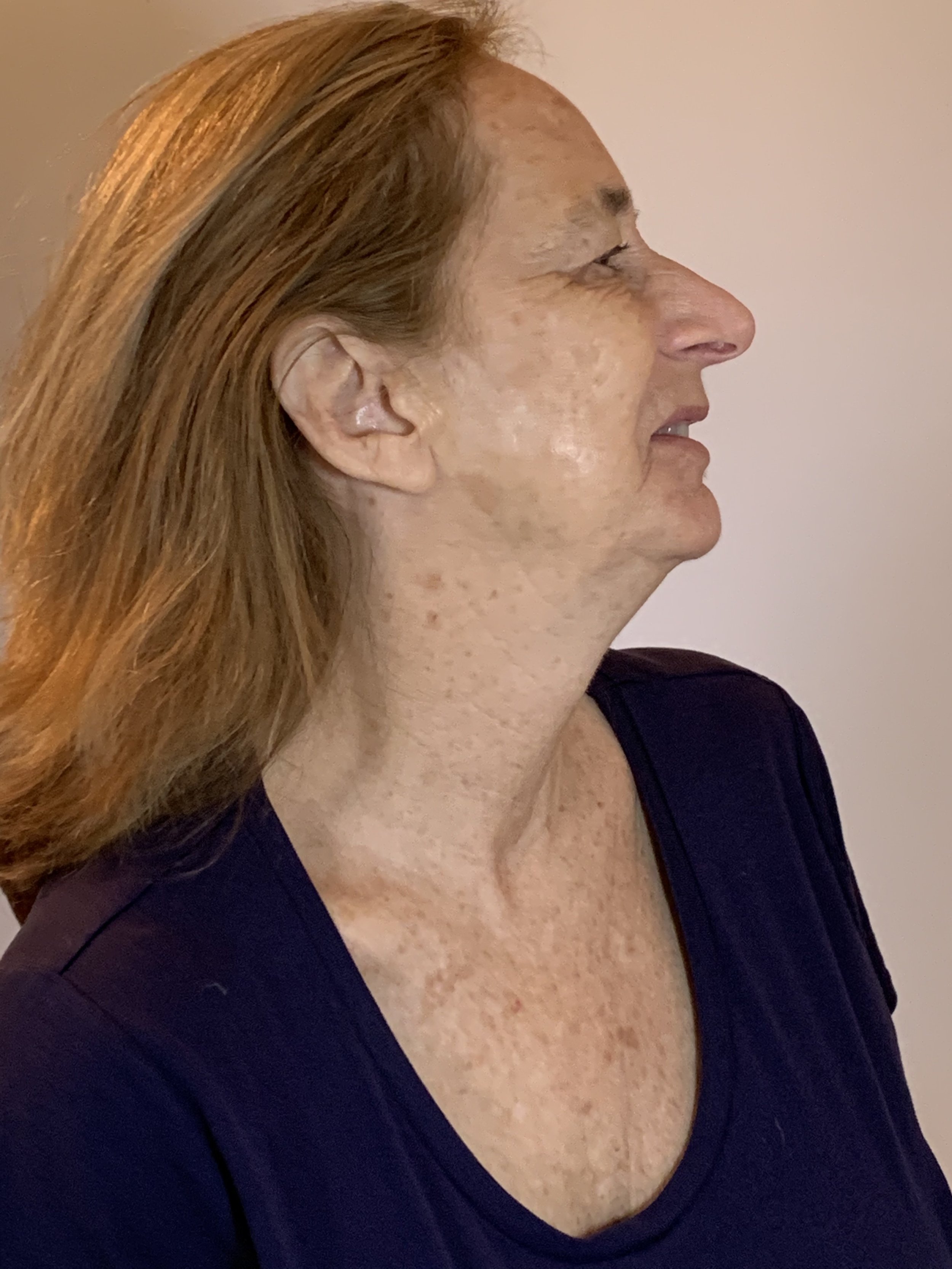 LimeLight Facial | Light Facial Therapy | Victoria BC — Laser Vantage