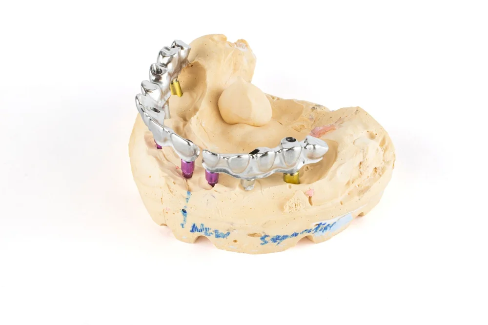Anatomical Bridge (Full-Arch) — Osteon Medical