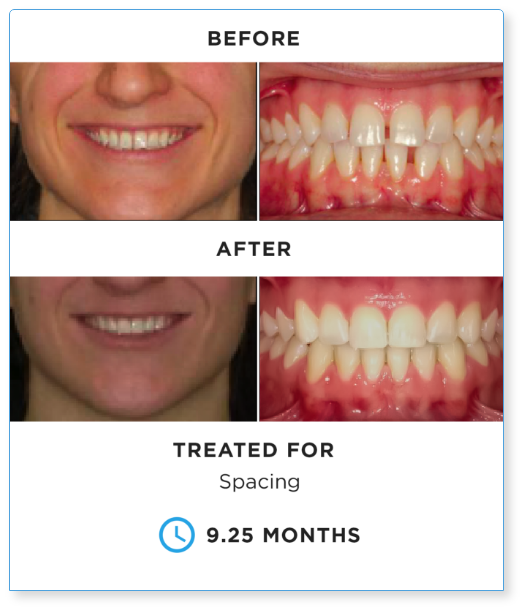 Achieve Straighter Teeth with SureSmile® Clear Aligners — Mayfield Smiles
