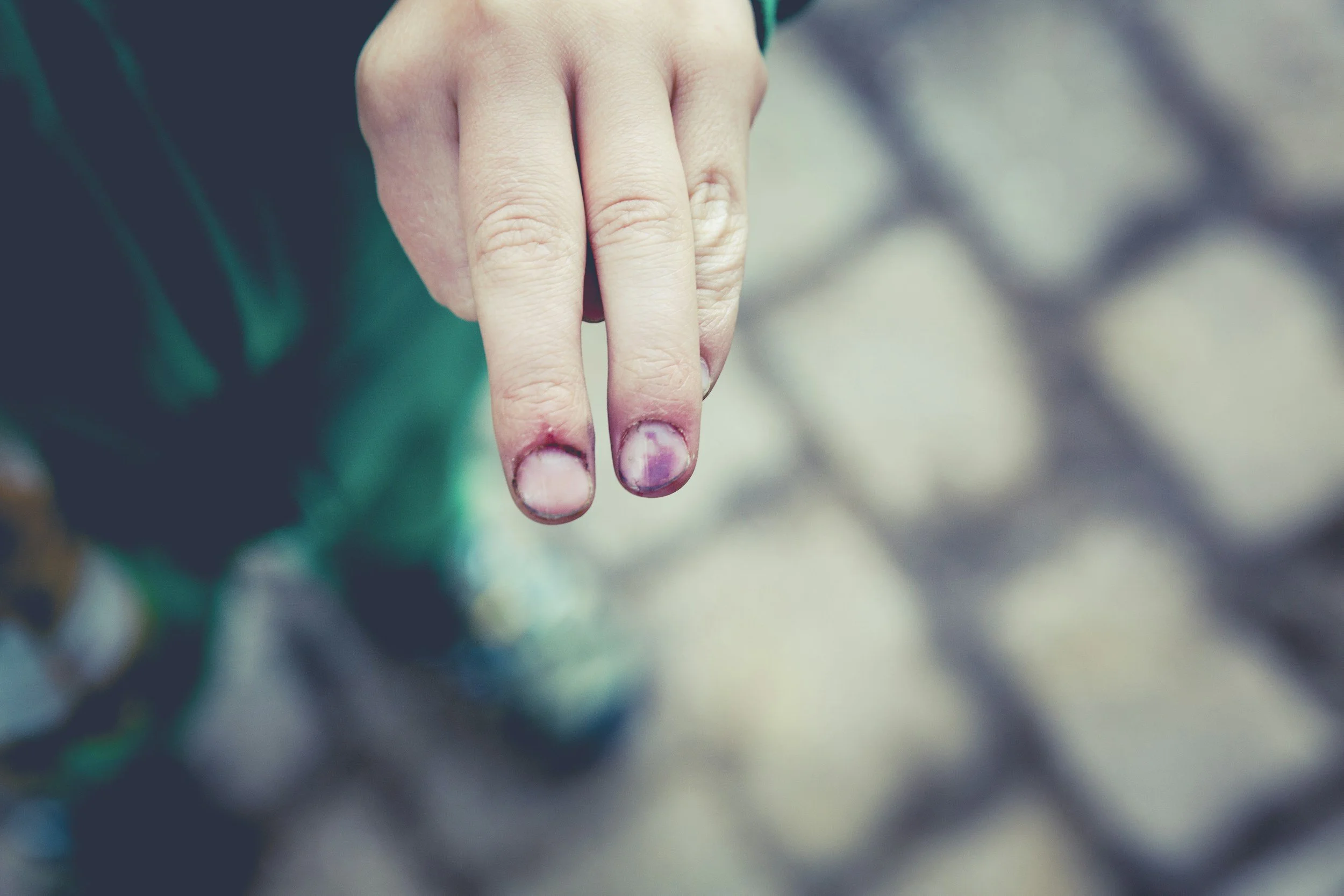 Does Smoking Weed Slow Wound Healing? Medical Facts Explained ...