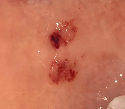 The 4 Canker Sore Stages (With Pictures) — Canker Shield