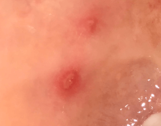 The 4 Canker Sore Stages (With Pictures) — Canker Shield