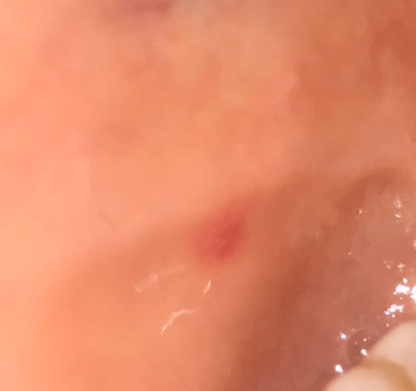 The 4 Canker Sore Stages (With Pictures) — Canker Shield