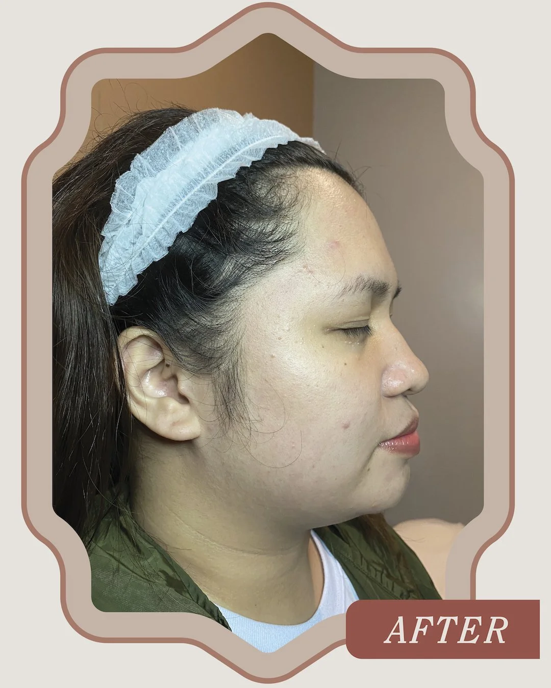 Before and After — Simply Skin