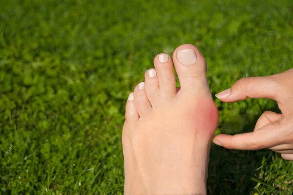Lapiplasty Bunion Surgery - 10 Important Things for Recovery — Foot ...