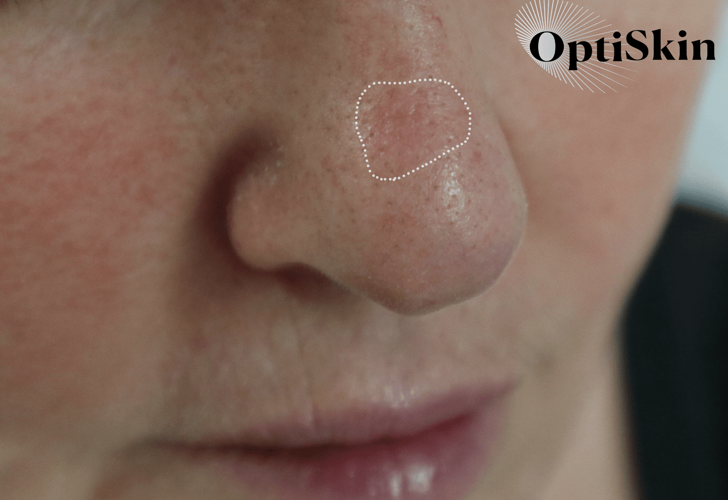 Basal Cell Carcinoma — Dermatology Skin Cancer Experts 2705