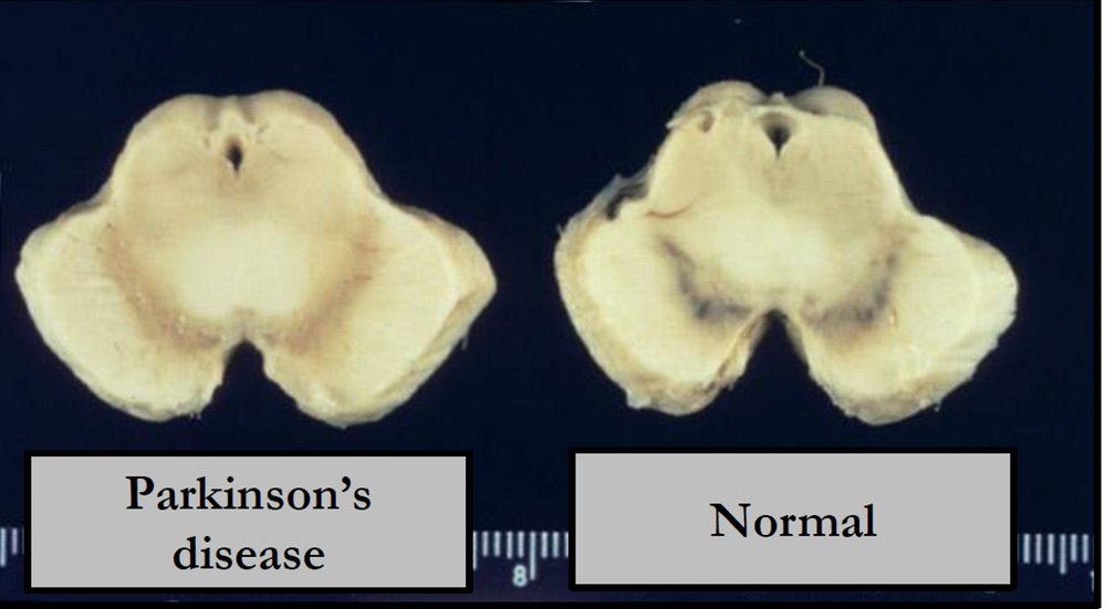 Progression of Parkinson's Disease — NeuroLab 360