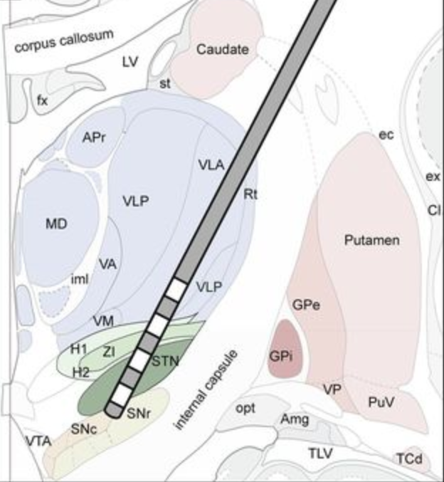 What is Deep Brain Stimulation (DBS)? — NeuroLab 360