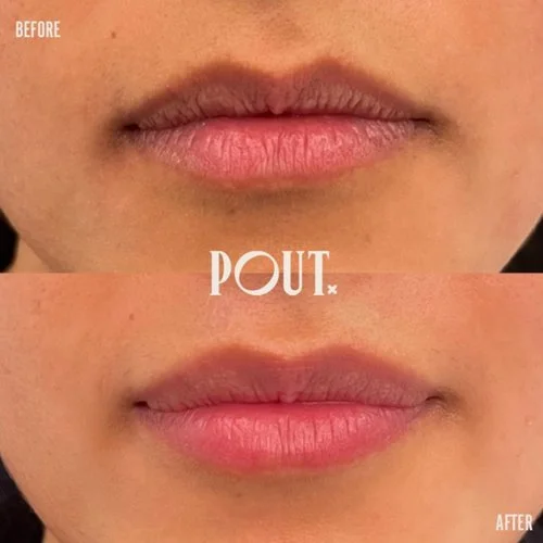 Gallery — Botox & Filler by The POUT Clinic | REAL Results. ZERO confusion.