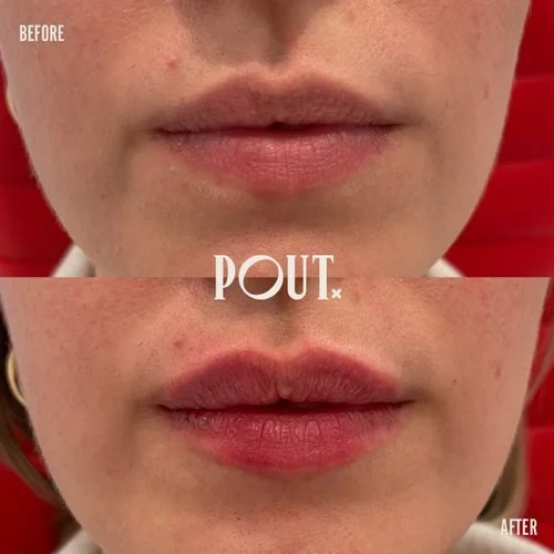 Gallery — Botox & Filler by The POUT Clinic | REAL Results. ZERO confusion.