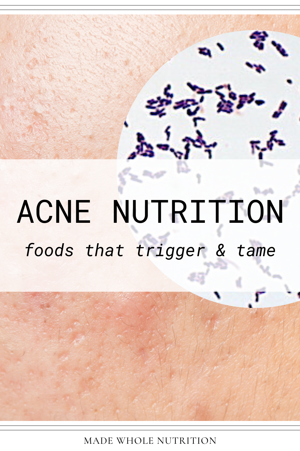 Acne Nutrition: foods that trigger & tame — Functional Health Research ...