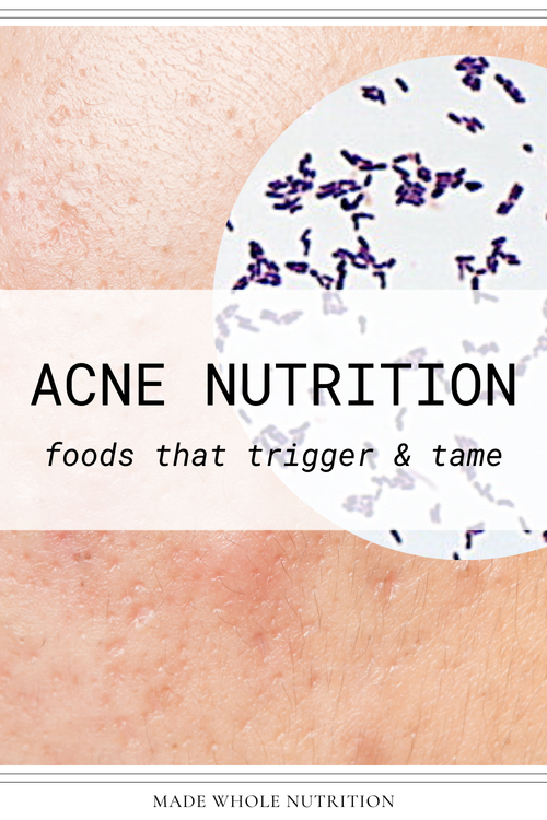 Acne Nutrition: foods that trigger & tame — Functional Health Research ...