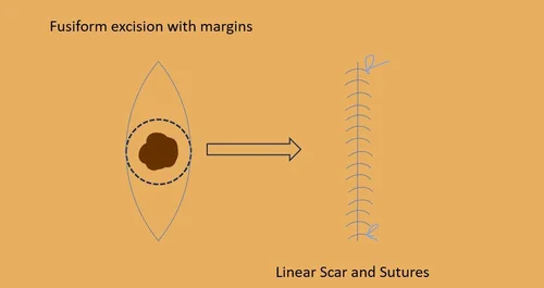 Comprehensive Guide to Skin Cancer Excisions and Aftercare According to ...
