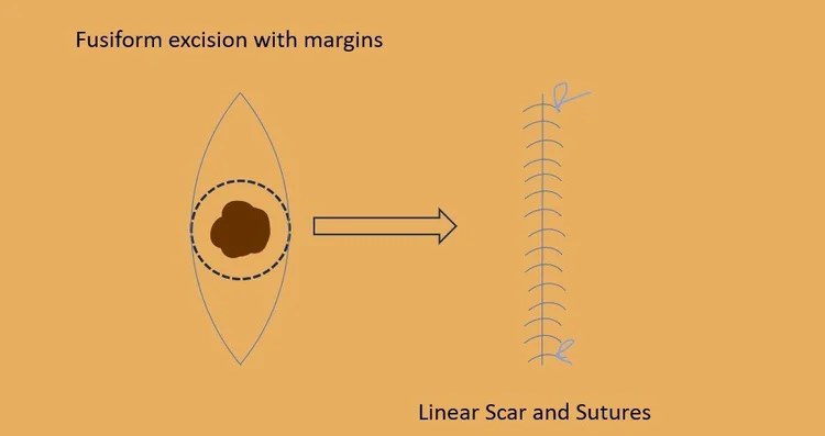 Comprehensive Guide to Skin Cancer Excisions and Aftercare According to ...