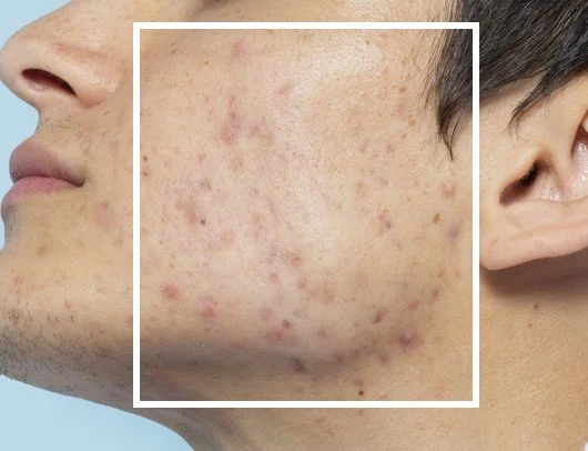 Dermatology Guide to Microneedling for Acne Scars (boxcar, rolling ...