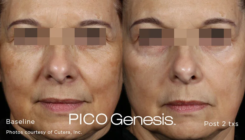 PICO Genesis & PICO Genesis FX — Eden Laser & Esthetics
