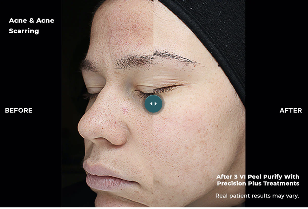 VI Peel: Achieve Radiant, Youthful Skin - Dover, NH — Beauty Mark ...