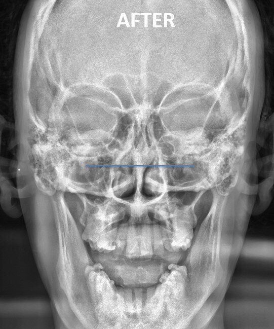 TREATMENT OF TMJ/ALF DISORDER — Maribel M. Vann DDS