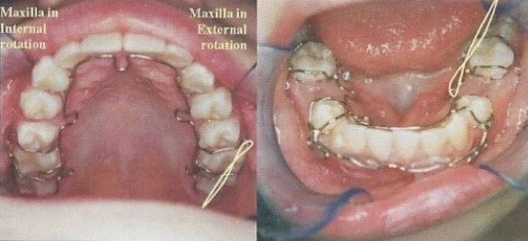 TREATMENT OF TMJ/ALF DISORDER — Maribel M. Vann DDS