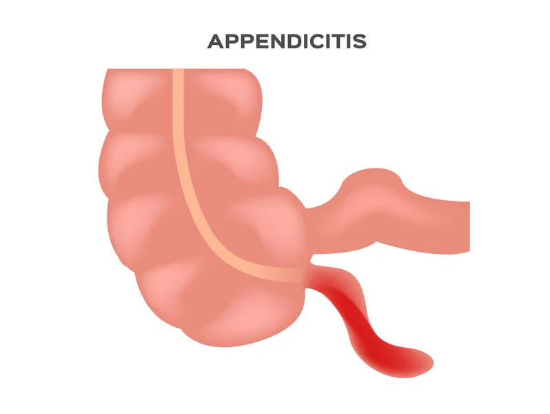 The Appendix and what it does. — Schopp Nutrition & Chiropractic Clinic