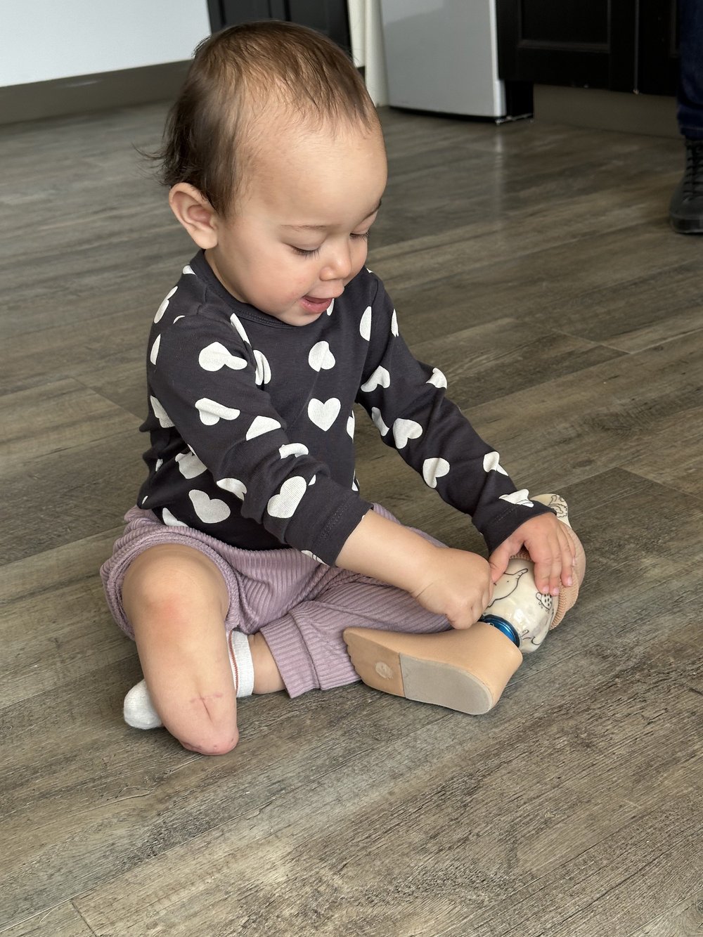 Pediatric Prosthetics and Bracing — Alberta Orthotic & Prosthetic Centre