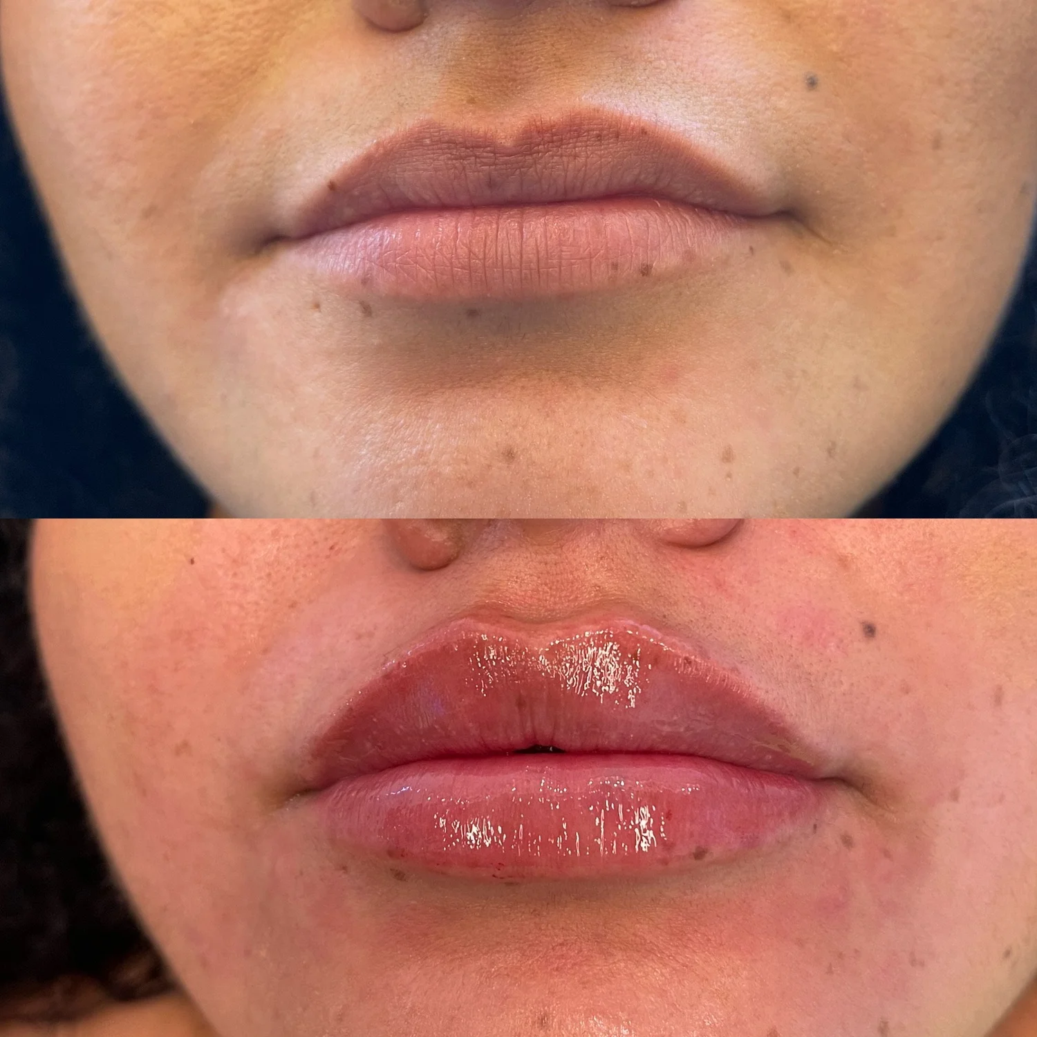 Best Lip Fillers in Austin, TX - Lip Augmentation | $349-$499 | Maui MedSpa
