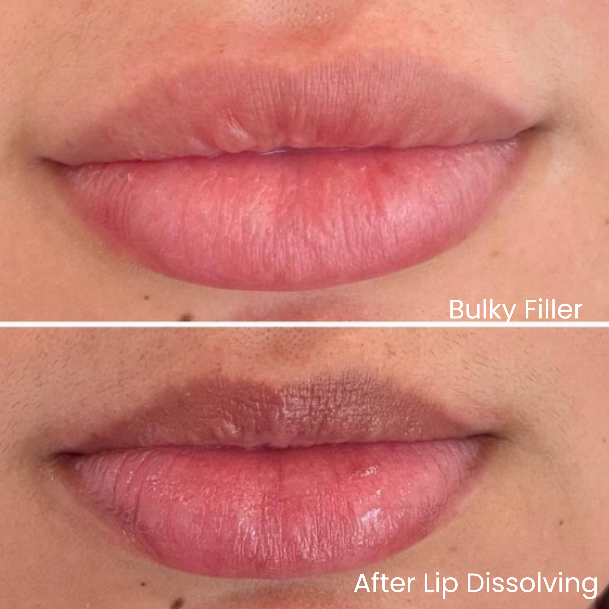 Lip Filler Dissolving Hylenex in Austin, TX | Maui MedSpa