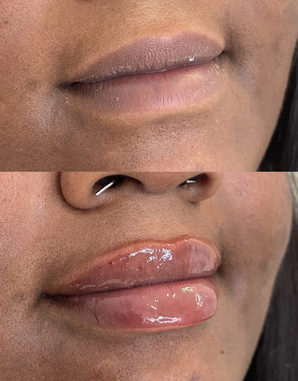 Lip Filler Migration Deep Dive: What It Is & What To Do — Maui MedSpa