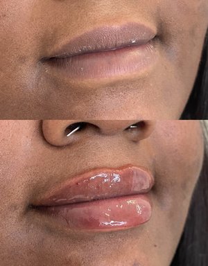Lip Filler Migration Deep Dive: What It Is & What To Do — Maui MedSpa